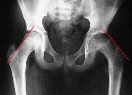 Epiphysiolyse de hanche - Outi