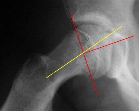 Epiphysiolyse de hanche - Outi