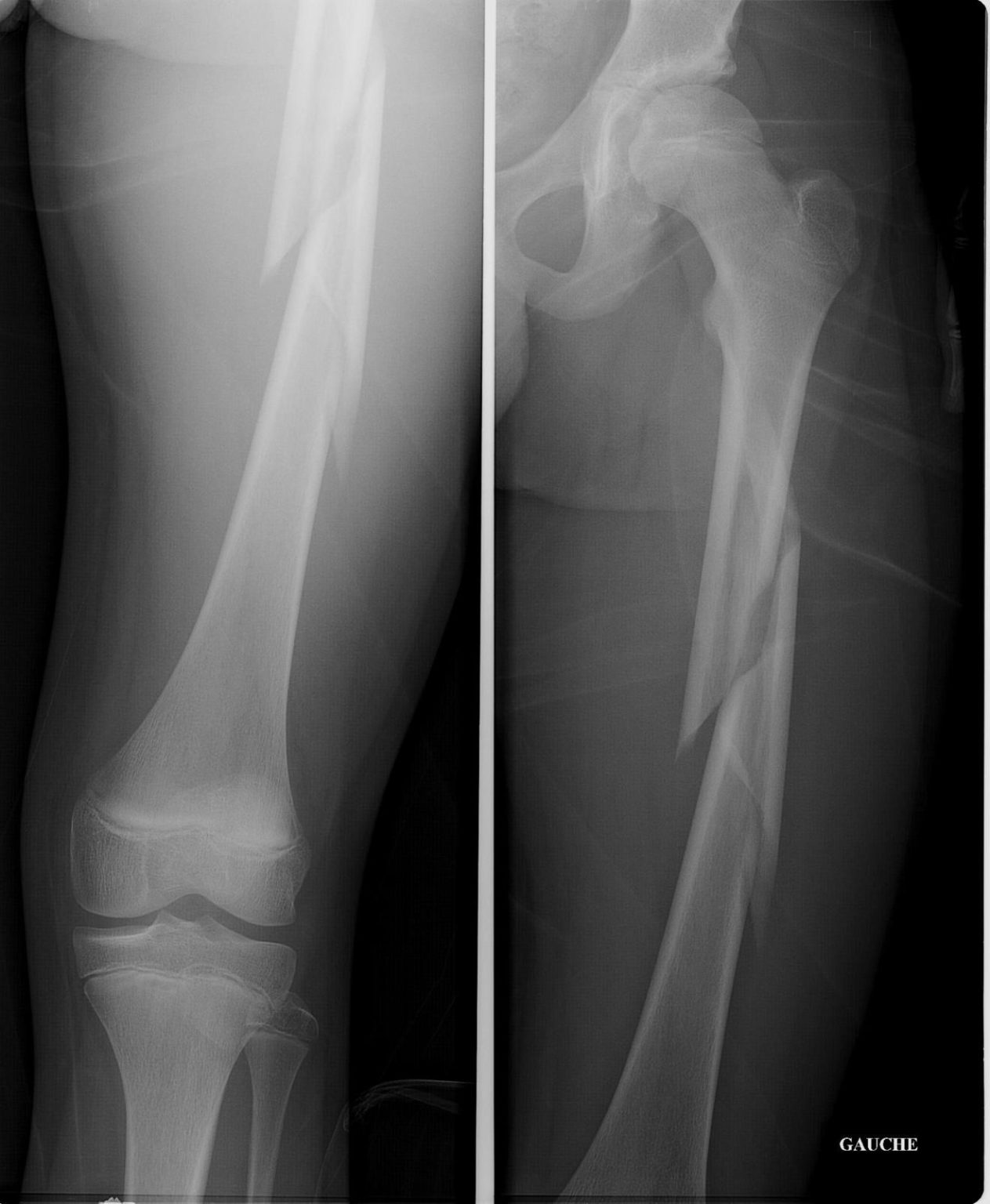 Fracture de la diaphyse fémorale - Outi