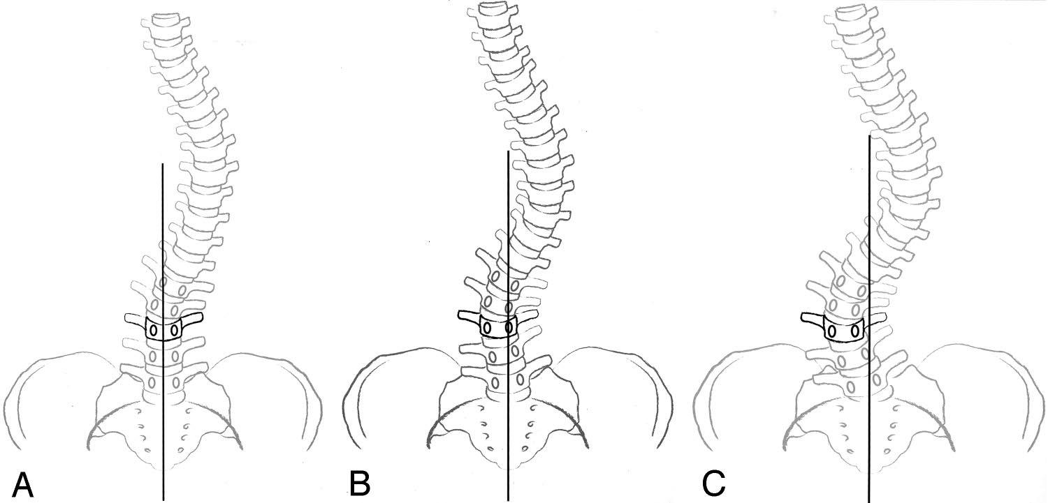 Classification de Lenke - Outi