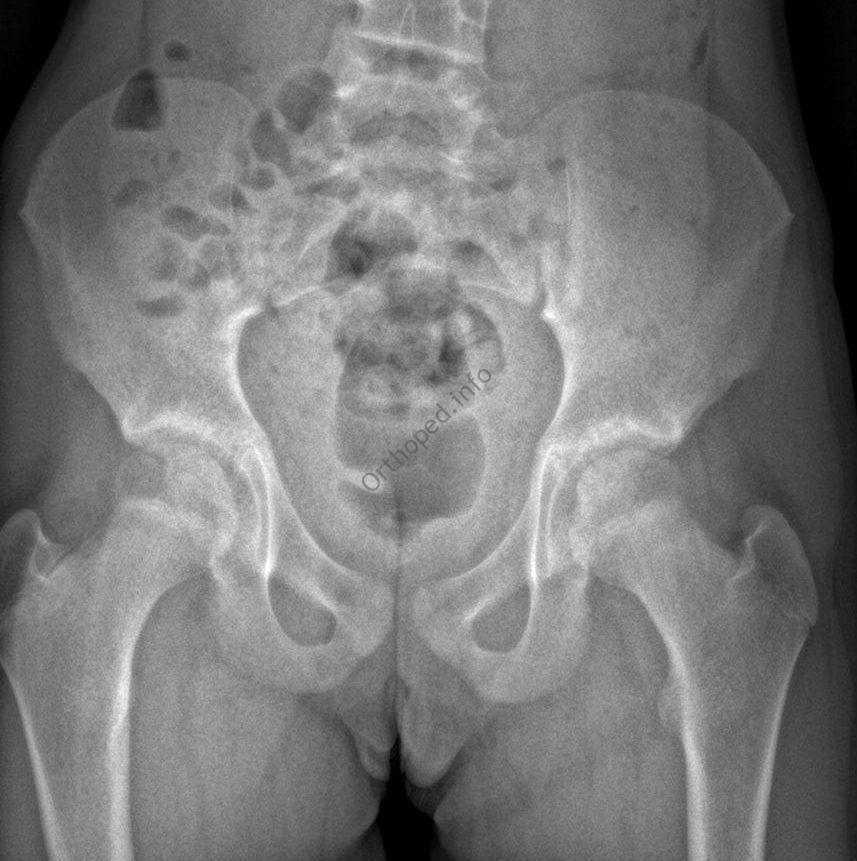 Test de Risser - Evaluation de la croissance résiduelle du rachis